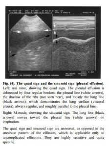 Below is an another example of the quad sign along with the sinusoid ...