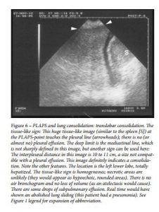 Interstitial syndrome generates lung rockets on lung ultrasound ( Fig 7 ...
