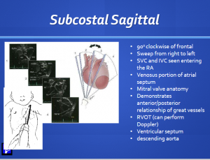 Subcostal Right Anterior Oblique View: 29
