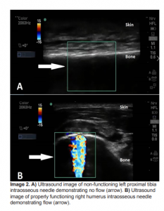 Subsequently, the tibial IO needle was removed and a second, 45 mm IO ...