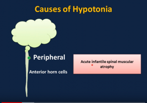 Remember that fasciculations is a common association with this illness.*