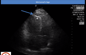 Normal versus McConnell’s Sign