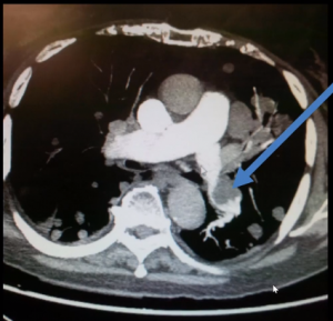 Well, unfortunately she was diagnosed with a large blood clot and right ...