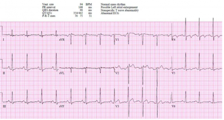 Patient 1 : myocarditis, COVID(-)