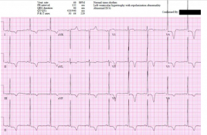 Patient 1 : Hypertrophic Cardiomyopathy (HCM), unnecessary cath lab ...