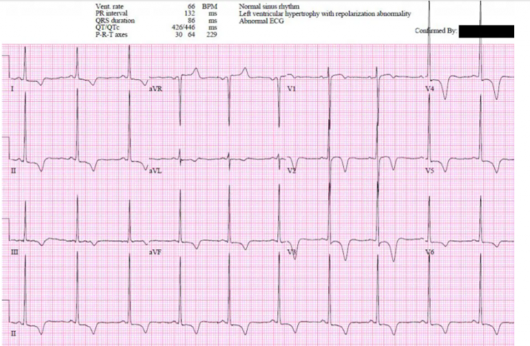 Patient 1 : Hypertrophic Cardiomyopathy (HCM), unnecessary cath lab ...