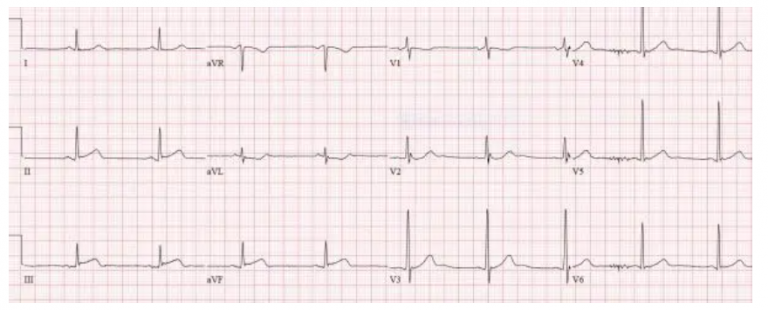 Patient 1 : missed inferior MI