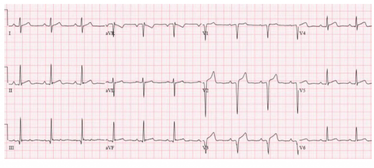 Patient 1 : 30yo smoker with chest pain radiating to the arm