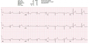 Patient 1: inferoposterolateral STEMI(+)/OMI(+)