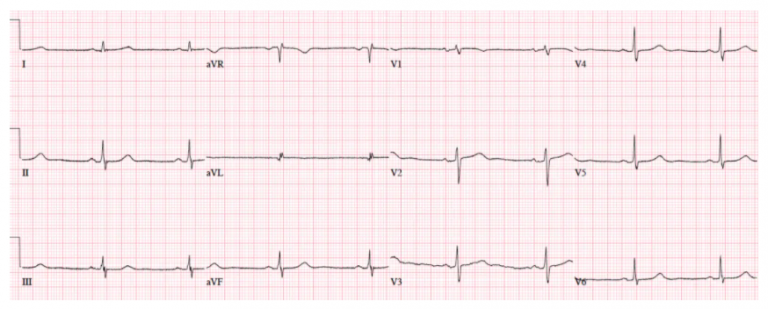 Here’s my analysis of the old ECG: