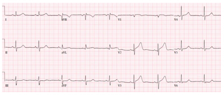My analysis of the new Case 5 ECG above: