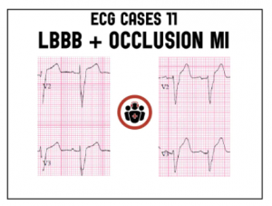 In this ECG Cases blog we look at 5 patients with potentially ischemic ...