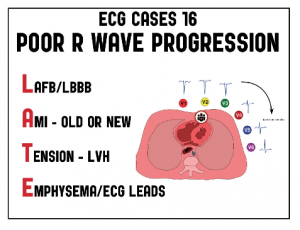In this ECG Cases blog we examine 6 patients who presented with poor R ...