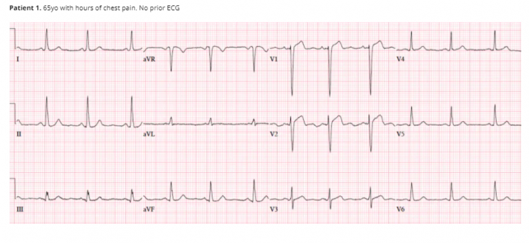 So here is my analysis of Case 1 ECG: