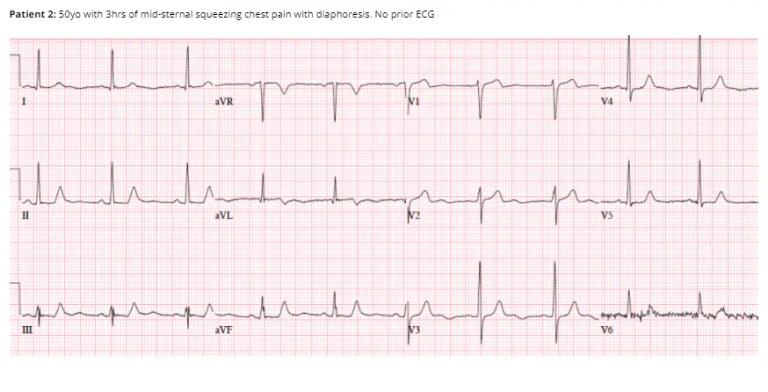 My analysis of ECG Case 2:
