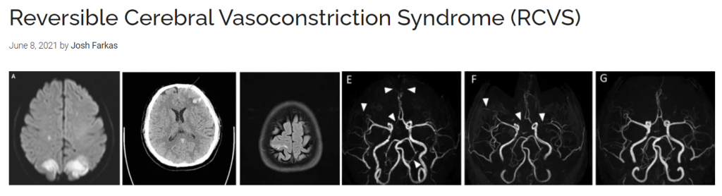 Reversible Cerebral Vasoconstriction Syndrome (RCVS) is an important cause of stroke and ...