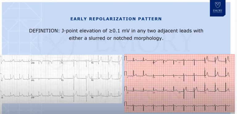 All that follows below are slides from Early Repolarization Syndrome ...