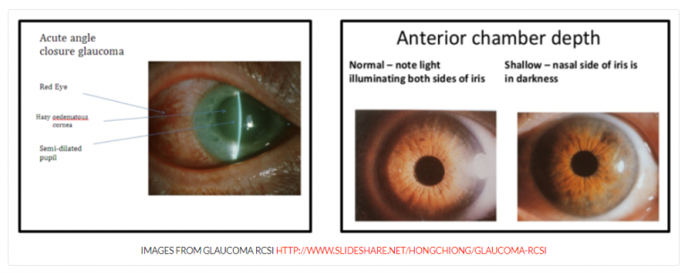 Acute angle closure glaucoma is a condition characterized by raised ...