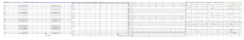 EEG is an increasingly utilized tool among critically ill patients ...