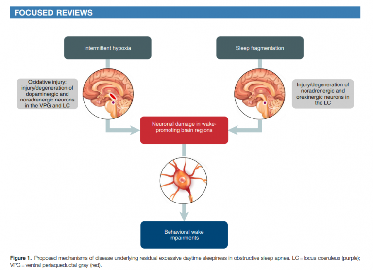 Clinical Evaluation of EDS in OSA