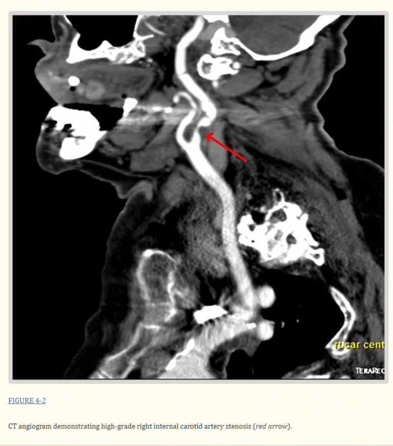 This entry was posted in American Academy Of Neurology , Transient ...
