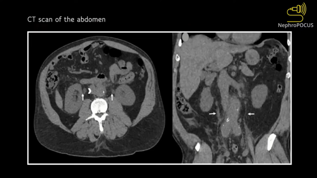 Fig11, 9:50. The pt recieved bilateral stents and the creatinine ...