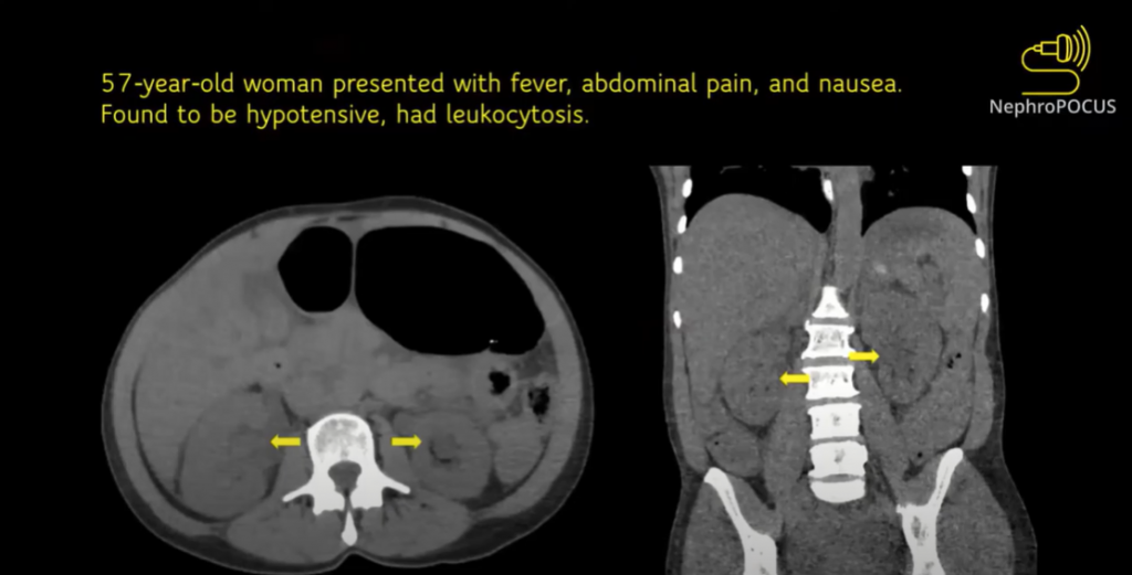 Fig14, 11:55 Below. Because the patient was septic and no source could ...