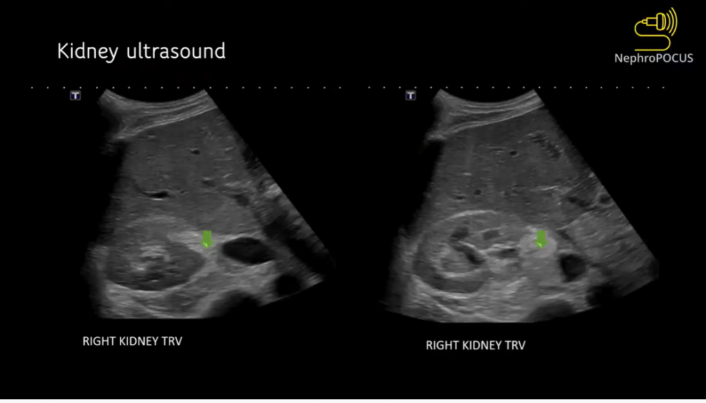 Fig16, 13:48, below. Another example. The oval shows a staghorn ...
