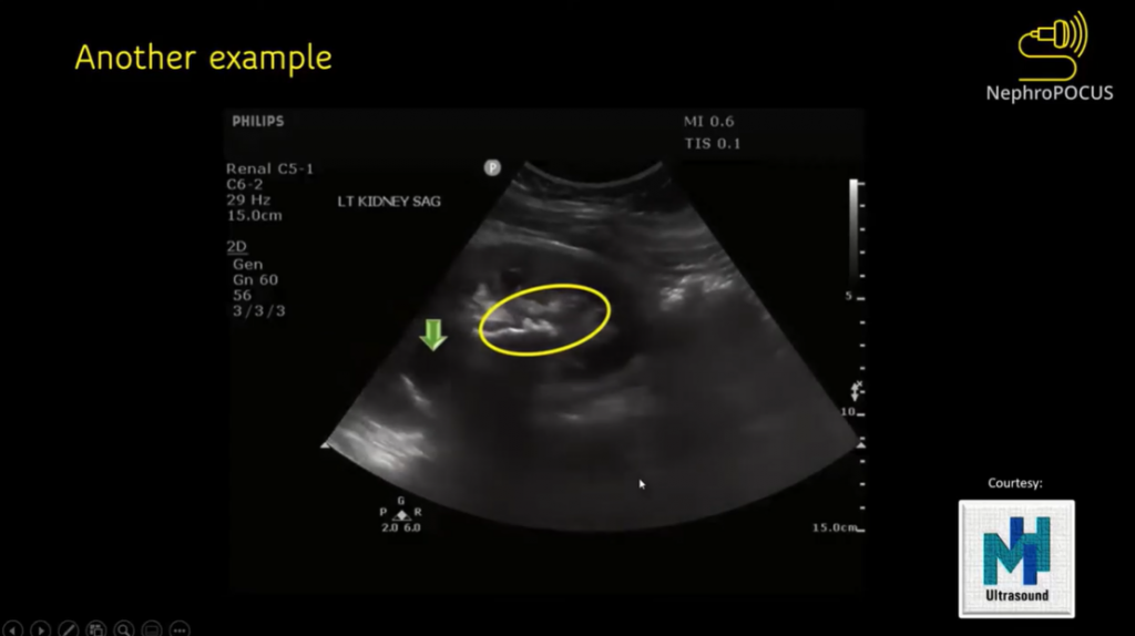 Fig17, below. This is a parapelvic cyst rather than hydronephrosis ...