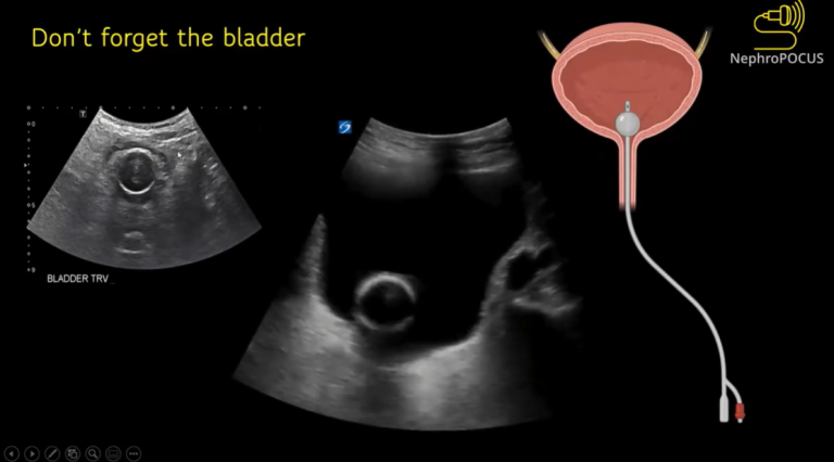 Now we come to the intrinsic causes of kidney injury.