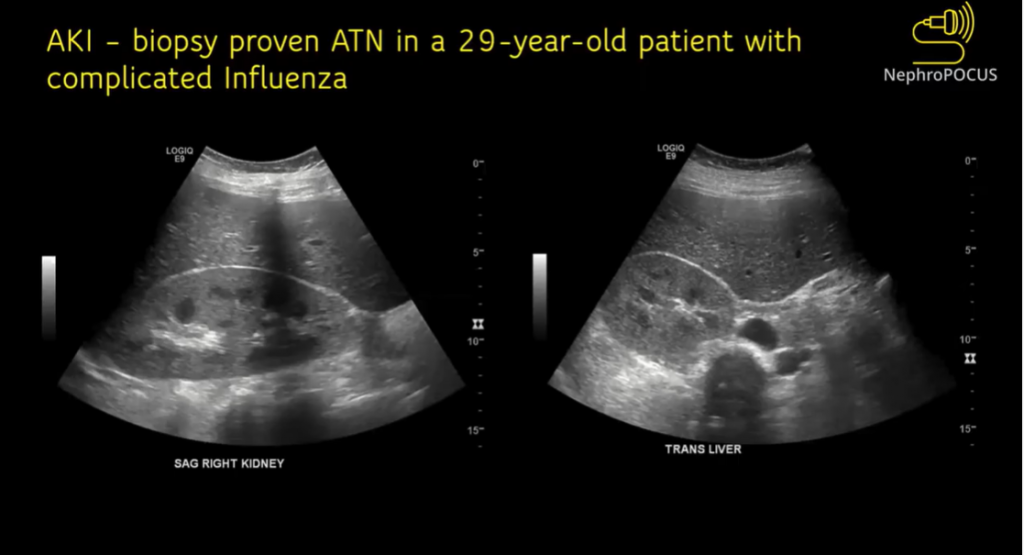 Linking To And Embedding “POCUS In Acute Kidney Injury” From ...