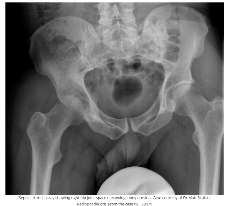 See also Normal radiographic anatomy of the hip from Radiopaedia