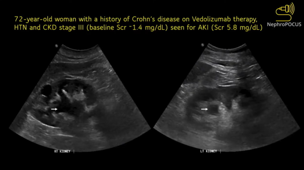 Fig 7, 6:56. Below the arrow points to a mass surrounding the left kidney.
