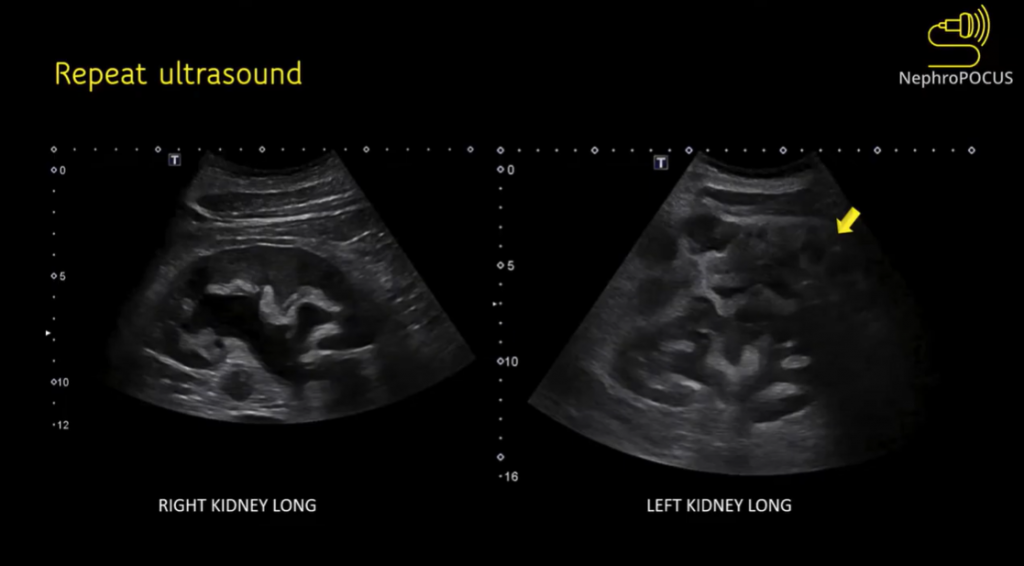 Fig8, 7:39. Below the arrows show a mass encircling the kidney causing ...