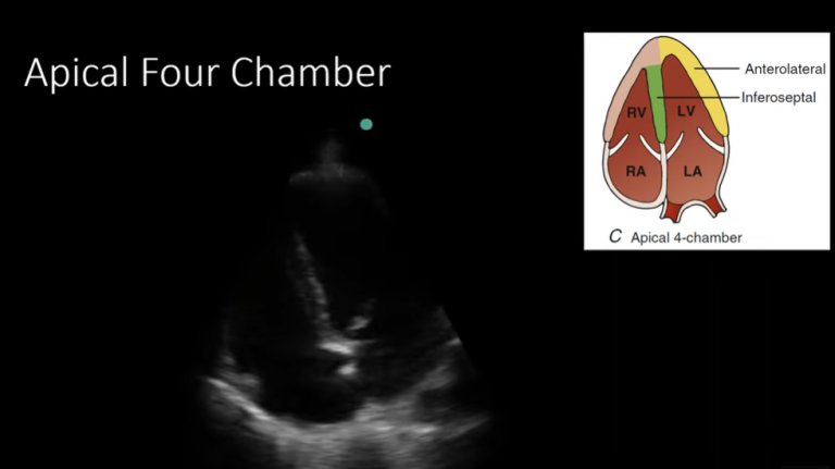 Remember, the great examples of the various wall motion abnormalities ...