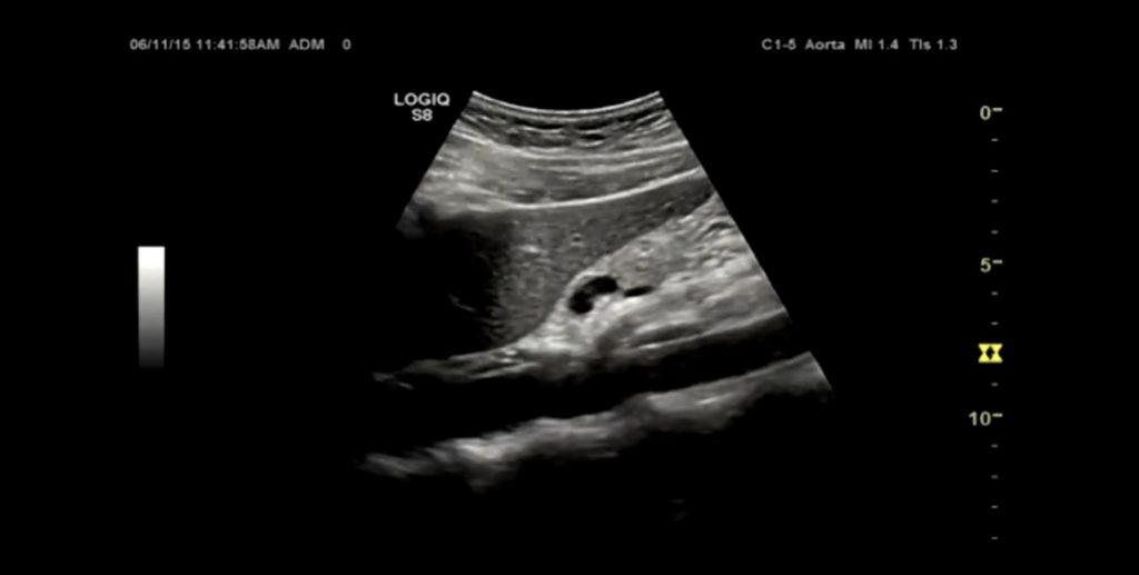 Bifurcation of the Aorta