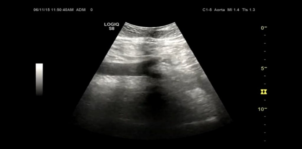 Short Axis of the Aorta in the center and the Inferior Vena Cava to the ...