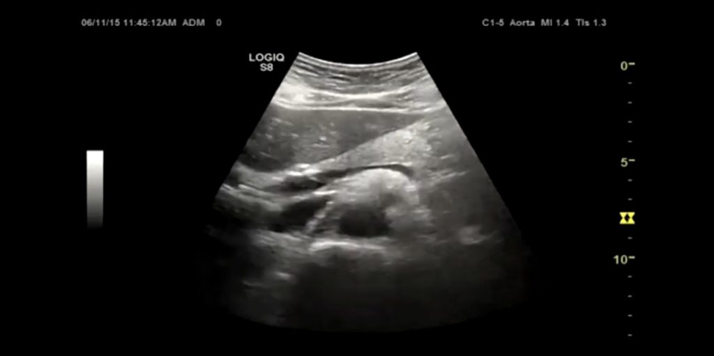 Celiac trunk dividing into the splenic artery and the common hepatic ...