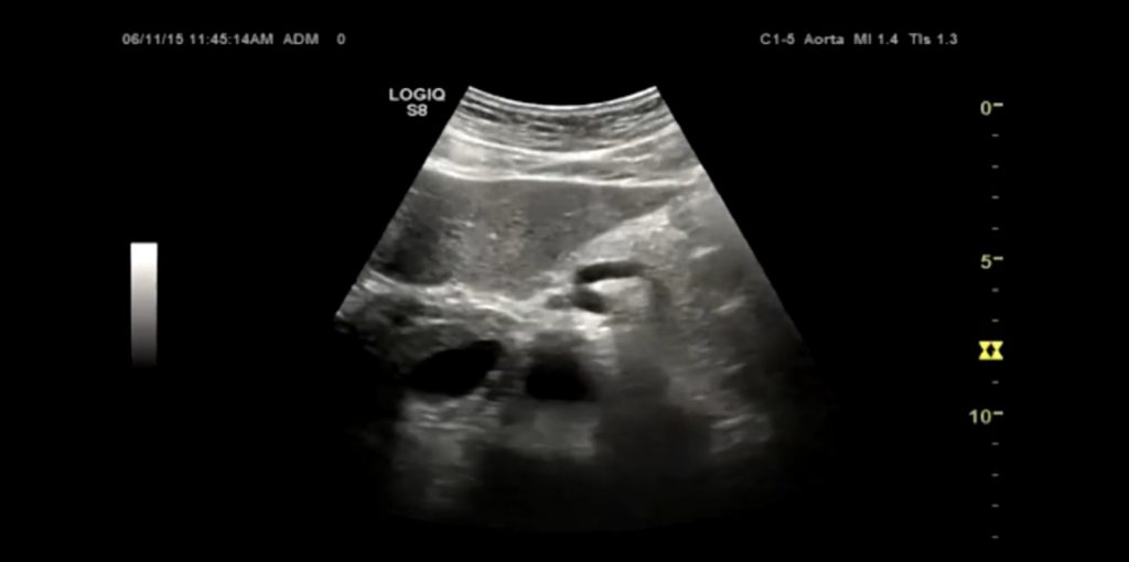 A little more distally on the aorta, we see the superior mesenteric ...