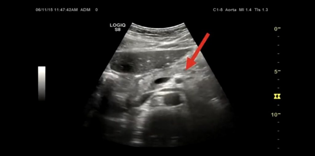 Above the superior mesenteric artery, is the splenic vein. And below ...
