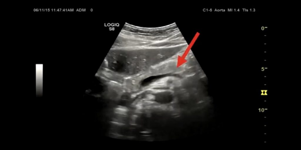 Distal to the SMA, you won’t generally see the Inferior Mesenteric Artery.