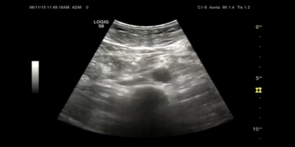 And next, we see the aorta bifurcating into the Iliacs.