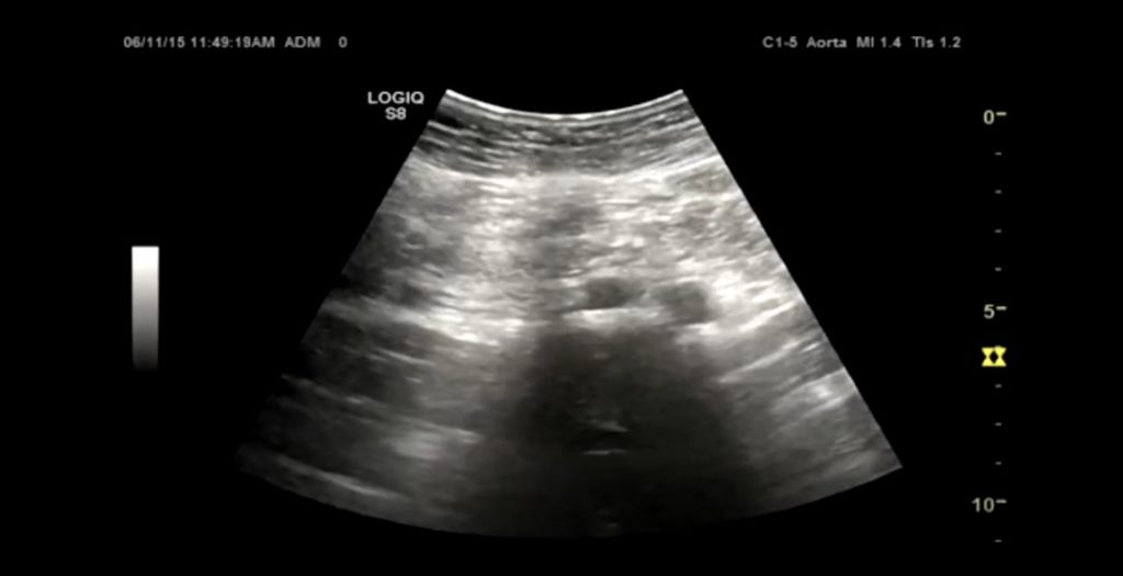 And next, we see the aorta bifurcating into the Iliacs.