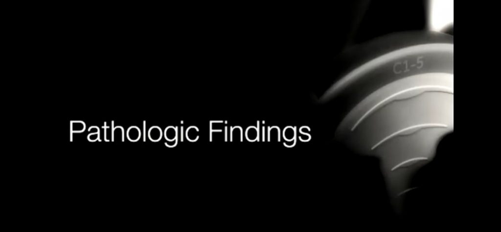 We measure the aorta from outer edge to outer edge.