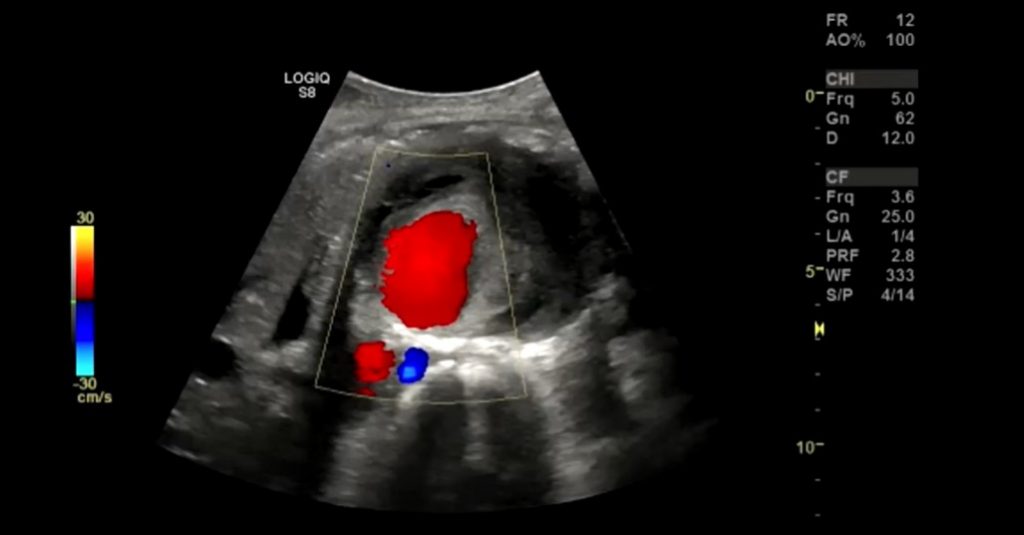 And here is the long axis. Note the large thrombus.