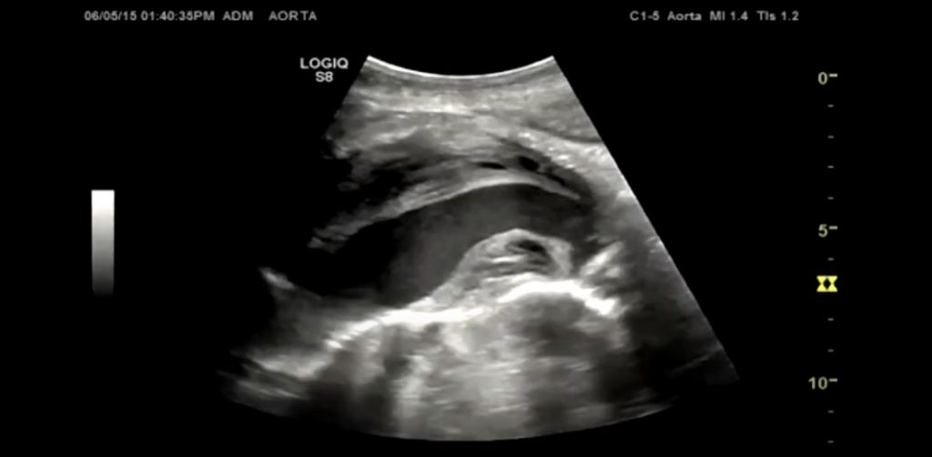 See all the echogenic thrombus.