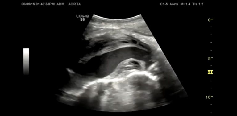 See all the echogenic thrombus.