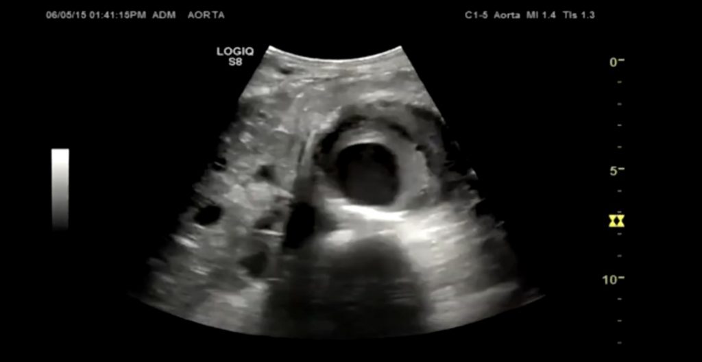 Another patient. Measured from outer wall to outer wall.