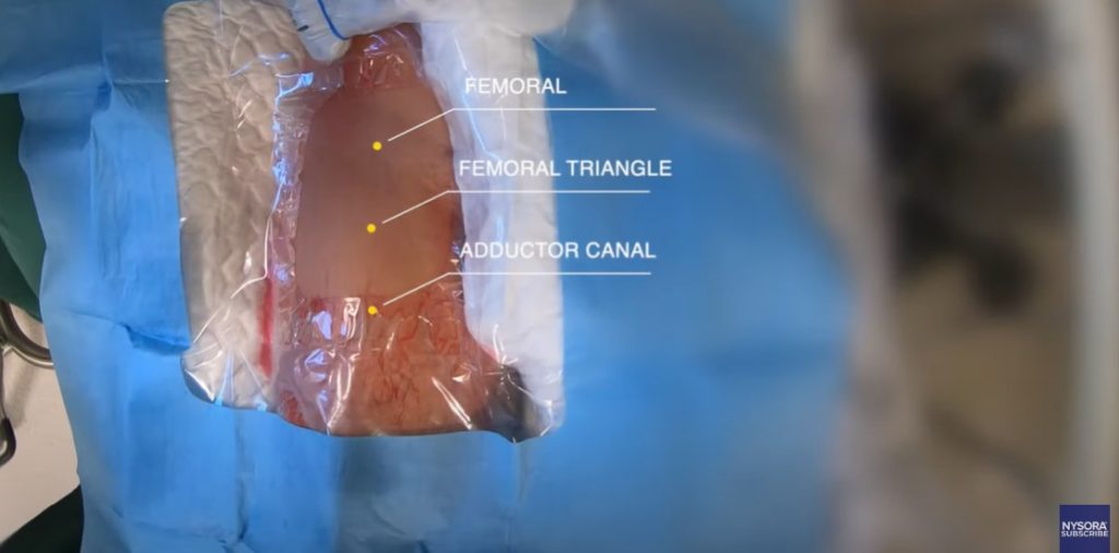 This entry was posted in Nerve Blocks , NYSORA Education . Bookmark the ...