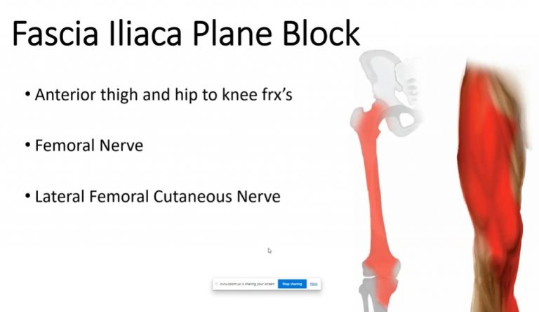 15:00 The above block should be the standard of care in hip fracture.